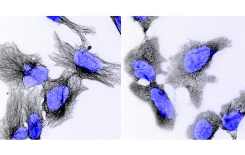 Potential treatment to bypass resistance in deadly childhood cancer ...